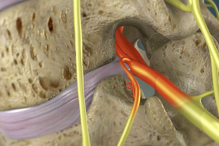 Endoscopic Foraminotomy - Spinomax